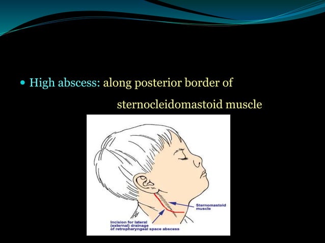 Surgical treatment of paraphyrngeal and retropharyngeal abscesses | PPTX