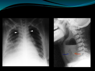 Peritonsillar Abscess X Ray