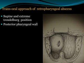 Retropharyngeal Abscess Drainage