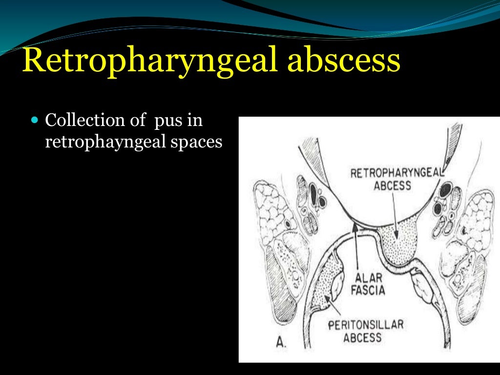 Surgical treatment of paraphyrngeal and retropharyngeal abscesses