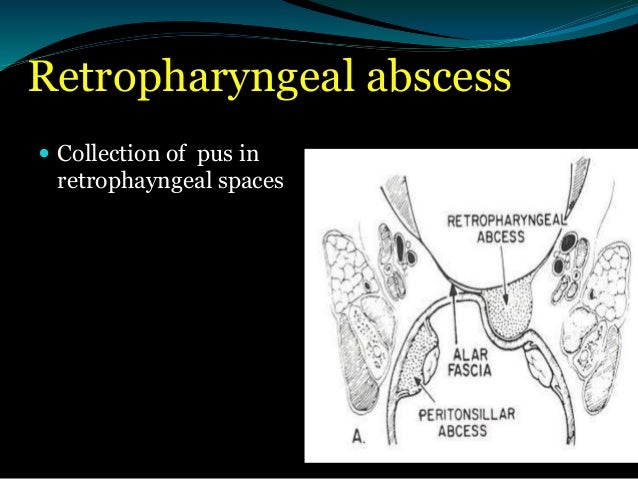 Surgical treatment of paraphyrngeal and retropharyngeal abscesses