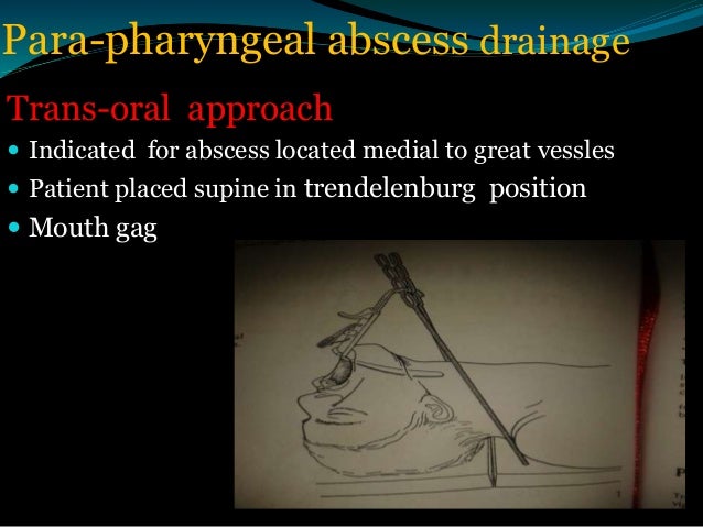 Surgical treatment of paraphyrngeal and retropharyngeal abscesses
