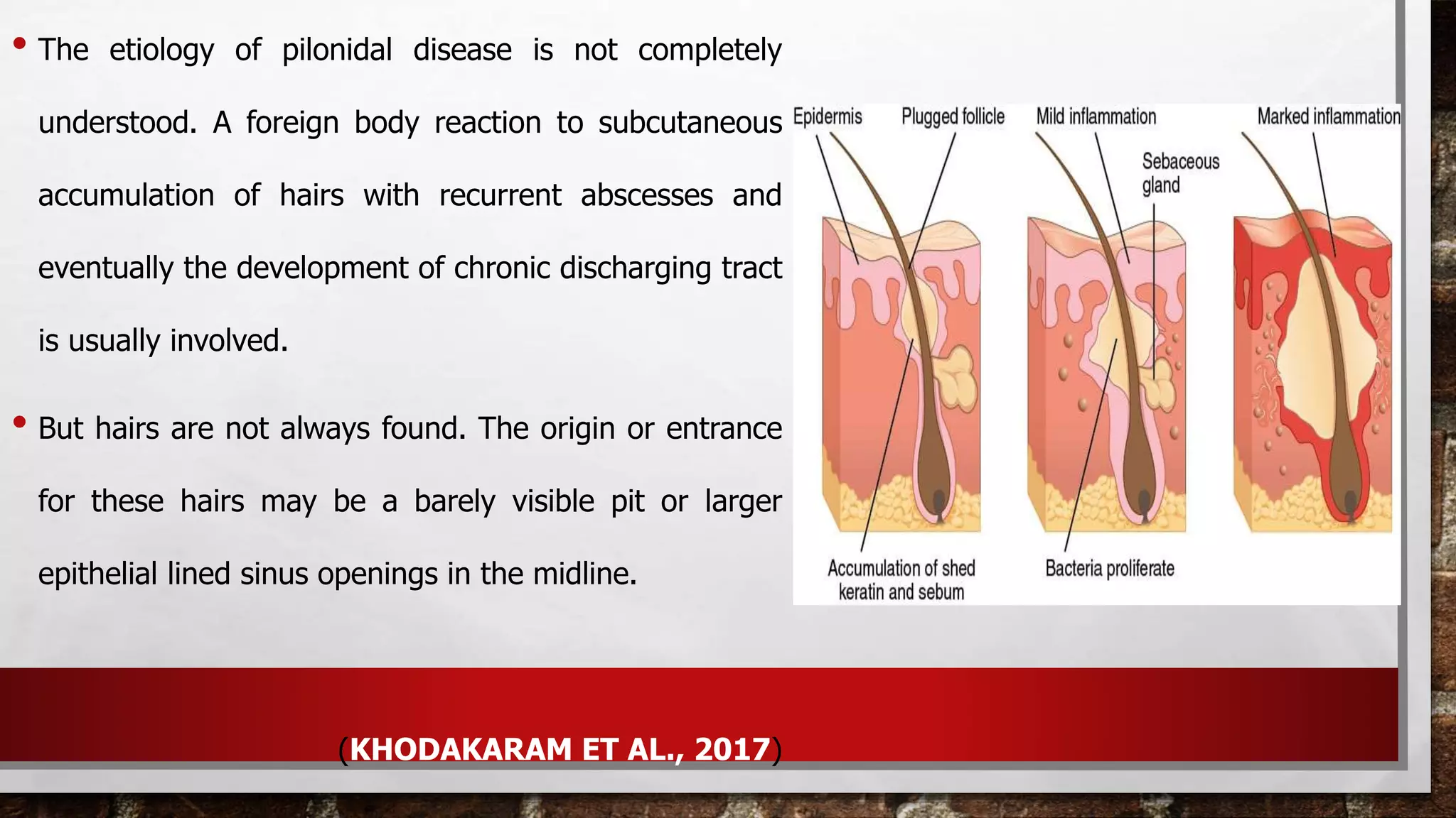 Surgical treatment of pilonidal disease | PPTX
