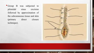 Surgical treatment of pilonidal disease | PPTX