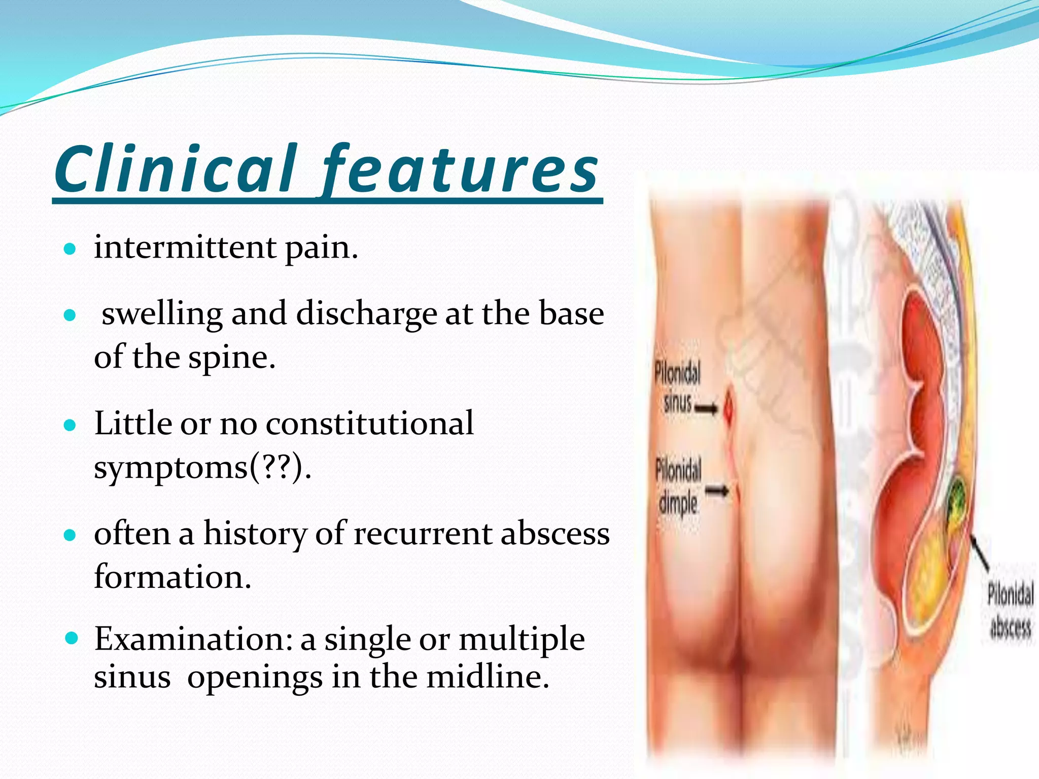 Surgical Treatment Of Pilonidal Disease Ppsx