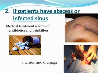 Surgical treatment of pilonidal disease | PPSX