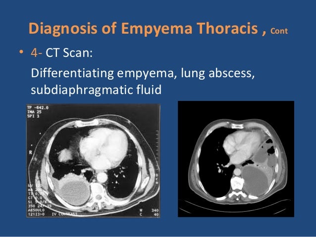 Surgical Treatment of Pleural Diseases