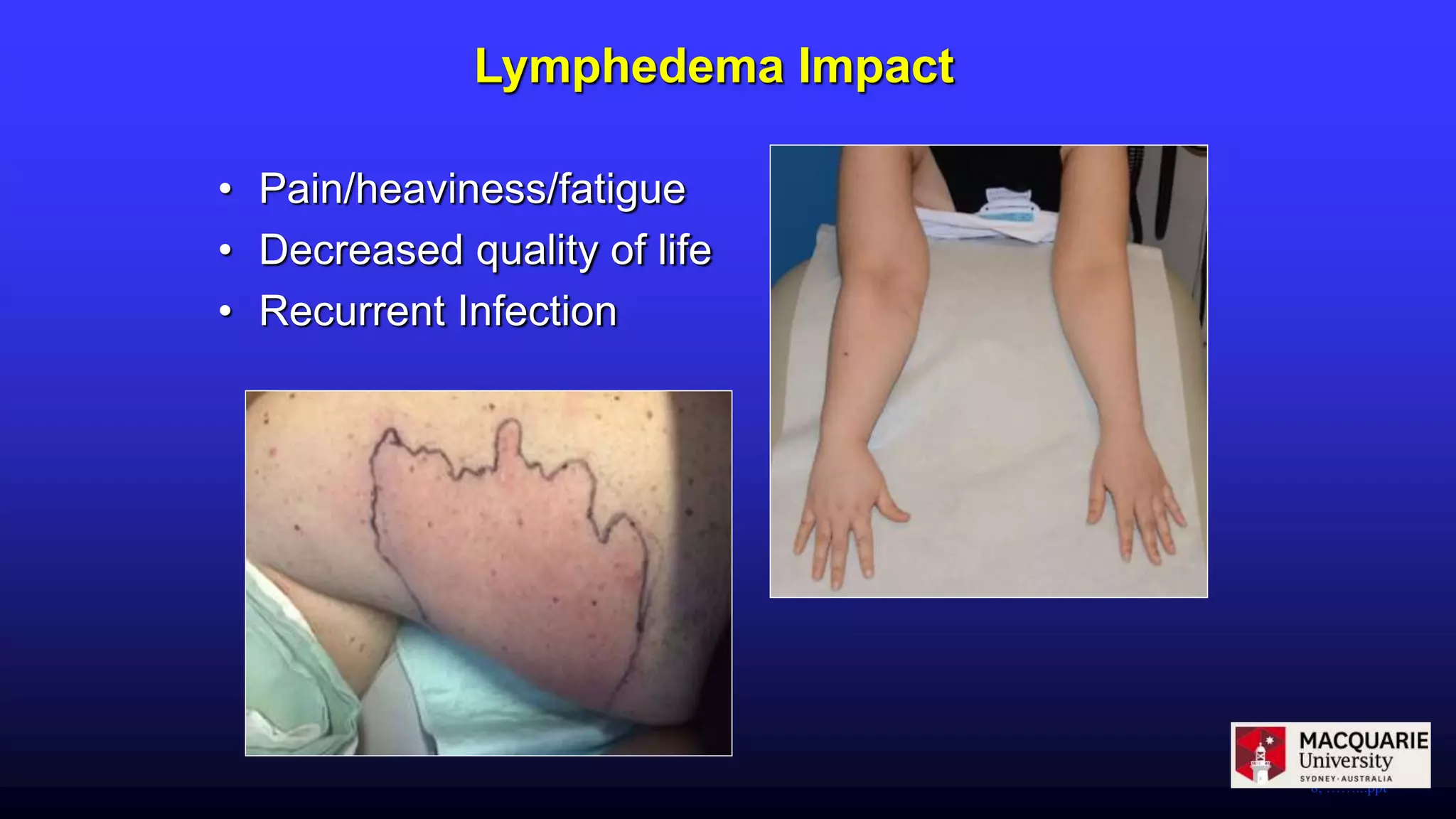 Surgical treatment of secondary lymphoedema—algorythimic approach at MD ...