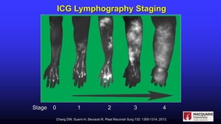 Surgical treatment of secondary lymphoedema—algorythimic approach at MD ...