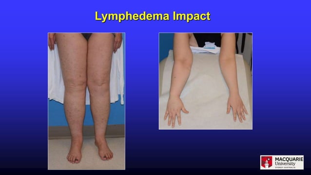 Surgical treatment of secondary lymphoedema—algorythimic approach at MD ...