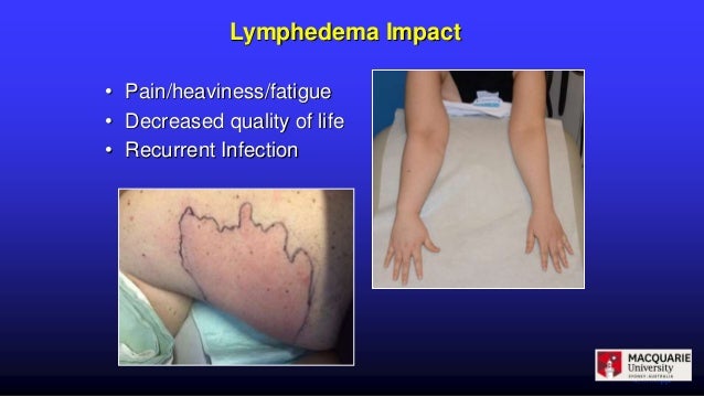 Surgical treatment of secondary lymphoedema—algorythimic approach at