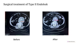 Surgical Treatment of Type II Endoleaks. | PPT