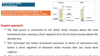 Surgical Treatment of Ulcerative Colitis.pptx