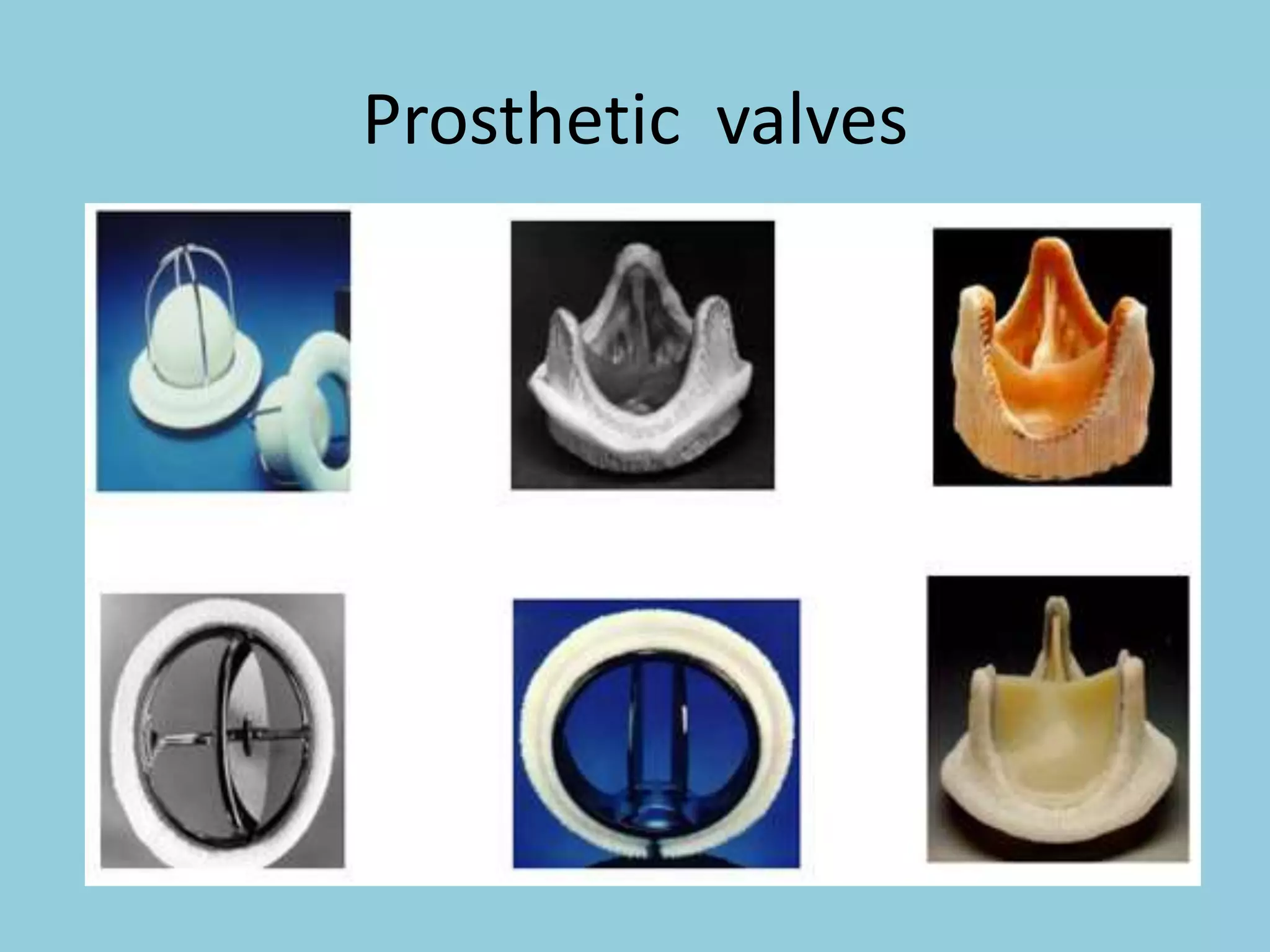 Surgical treatment of Valvular Heart diseases | PPTX