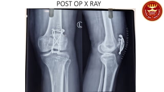 SURGICAL UNIT 1 GUDUDA DASS PATELLA Tension band wiring.pptx