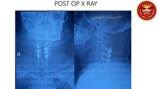 SURGICAL UNIT 1 PALANI C3-C4-C5 with compressive myelopathy.pptx