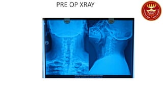 SURGICAL UNIT 1 PALANI C3-C4-C5 with compressive myelopathy.pptx