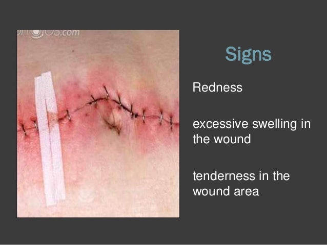 Wound Infection Signs
