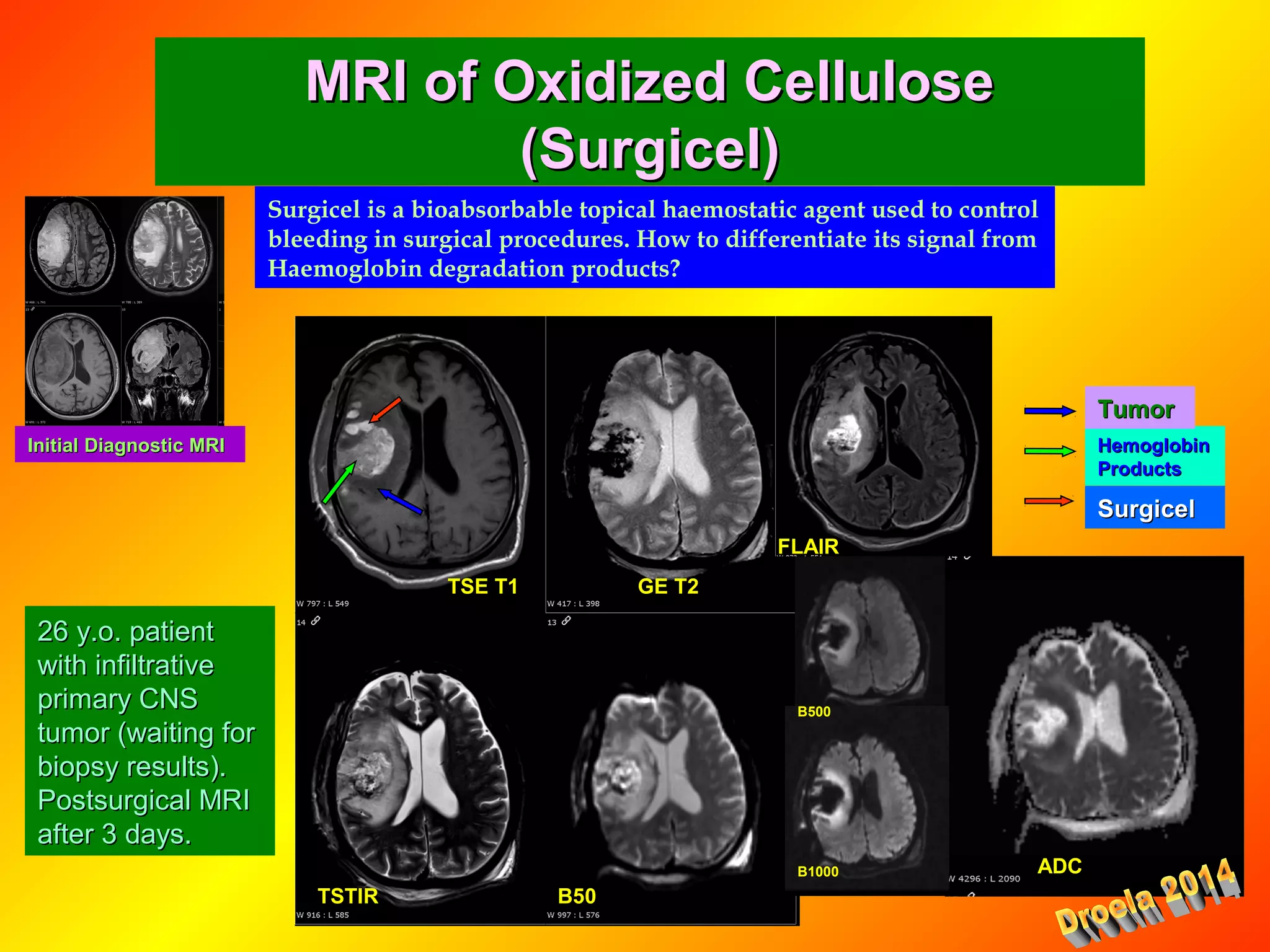 MRI of Oxidized Cellulose (Surgicel) | PPT | Medical Tests | Medical Health