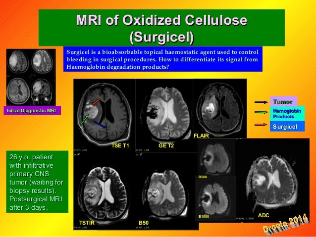 MRI of Oxidized Cellulose (Surgicel)