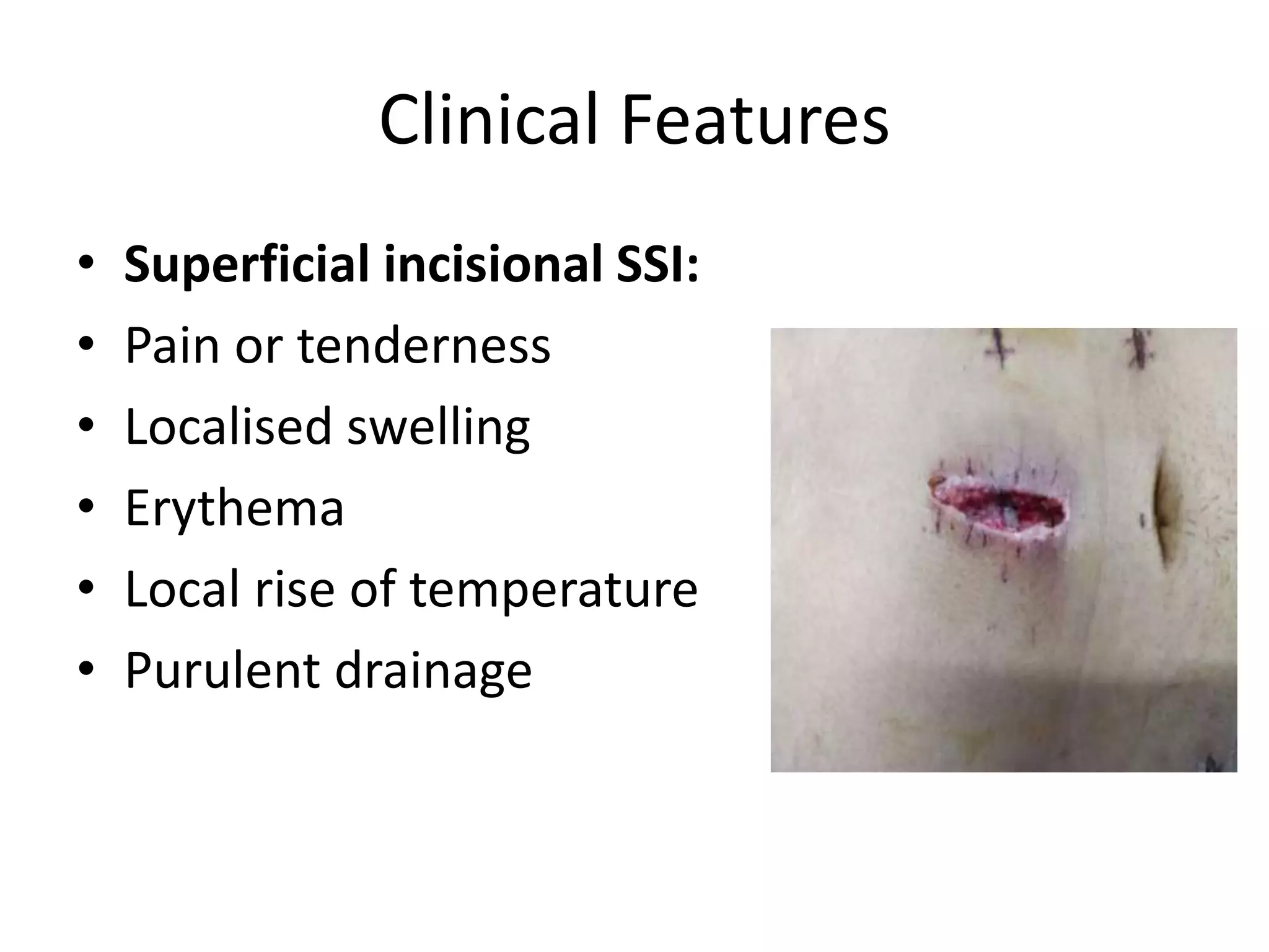 Surgical site infection | PPTX