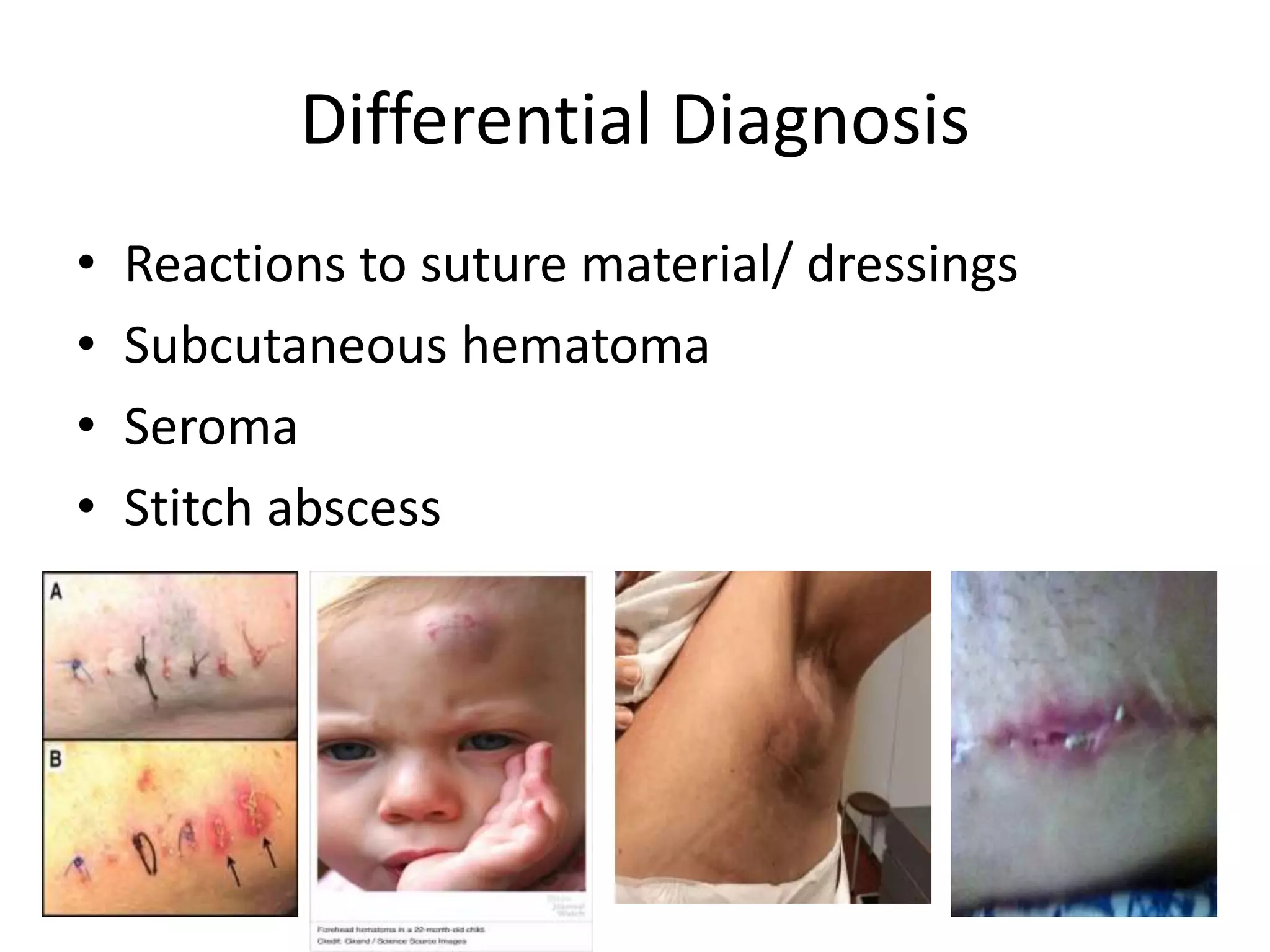 Surgical site infection | PPTX