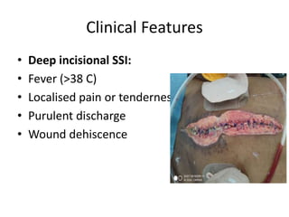 Surgical site infection | PPTX