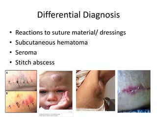 Surgical site infection | PPTX