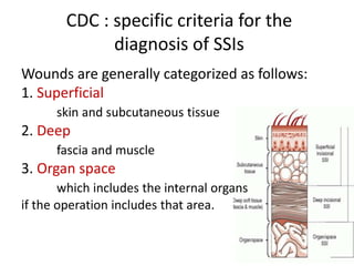 Surgical site infection | PPTX