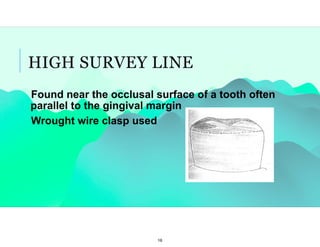 Surveying in removable partial denture.. | PDF