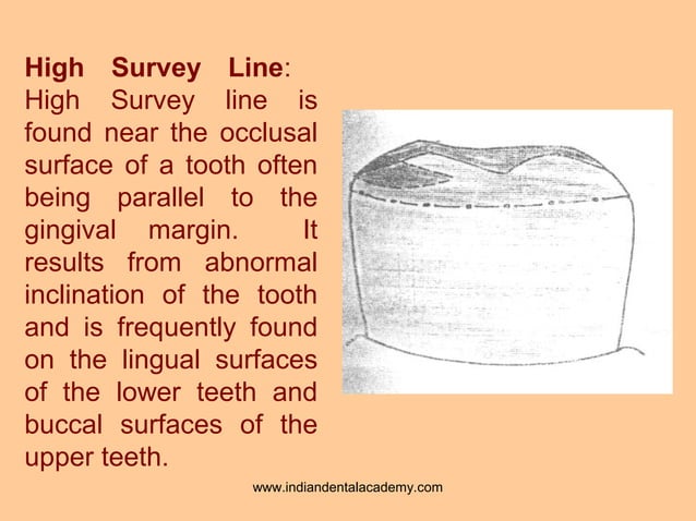 Surveying/ dentistry dental implants | PPT