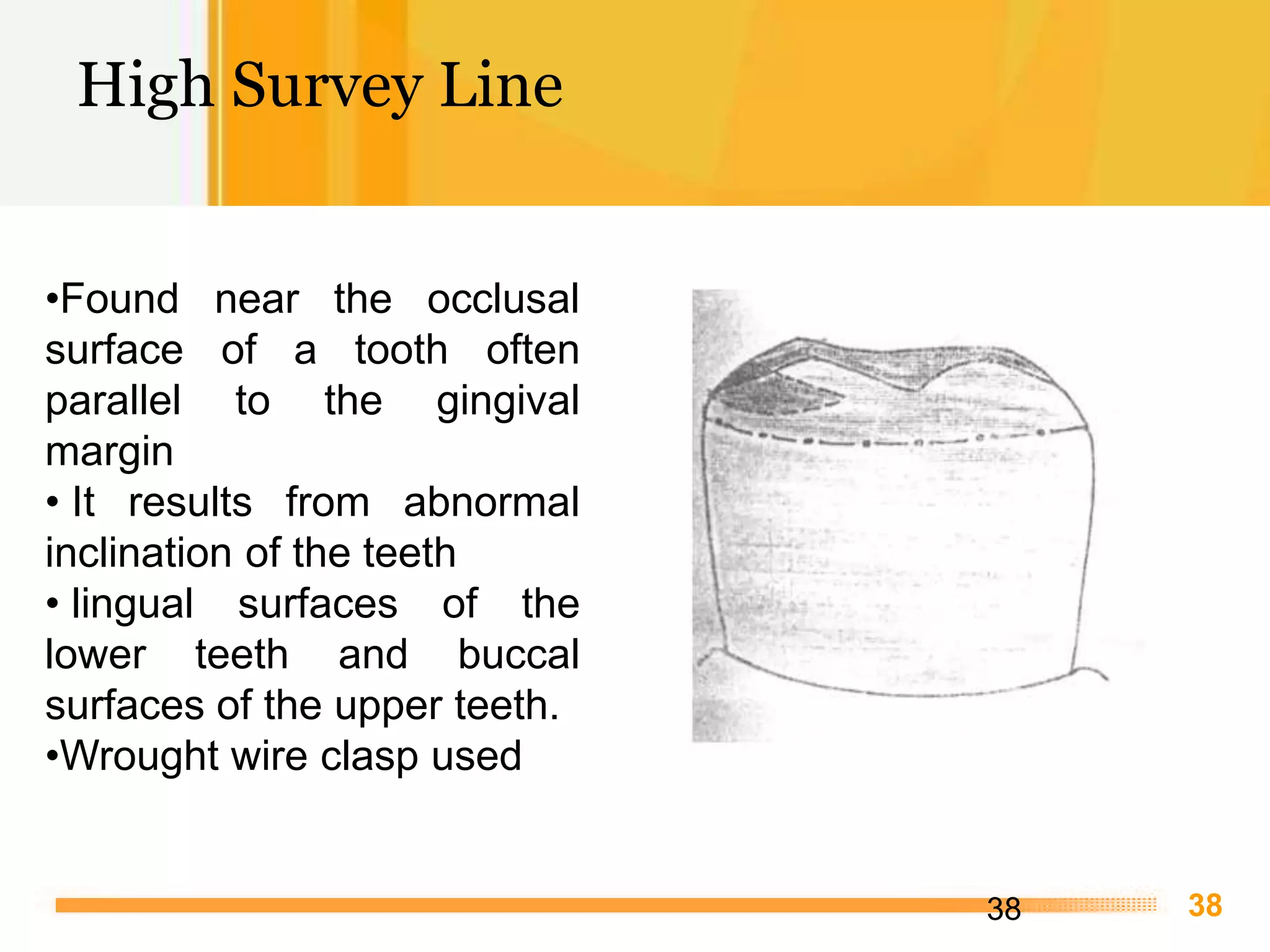 Surveyor and technique of Surveying in Removable partial denture | PPTX