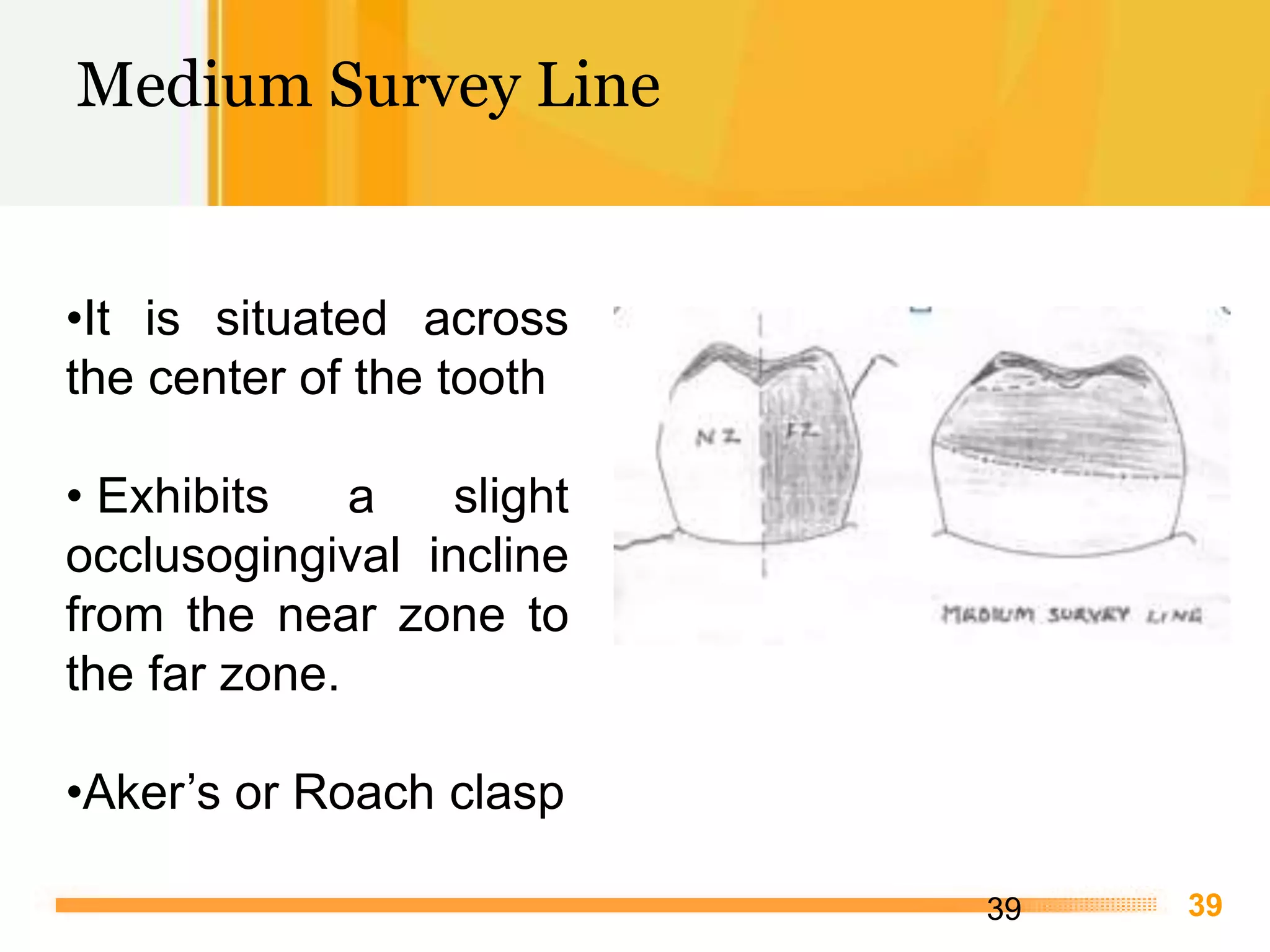 Surveyor and technique of Surveying in Removable partial denture | PPTX