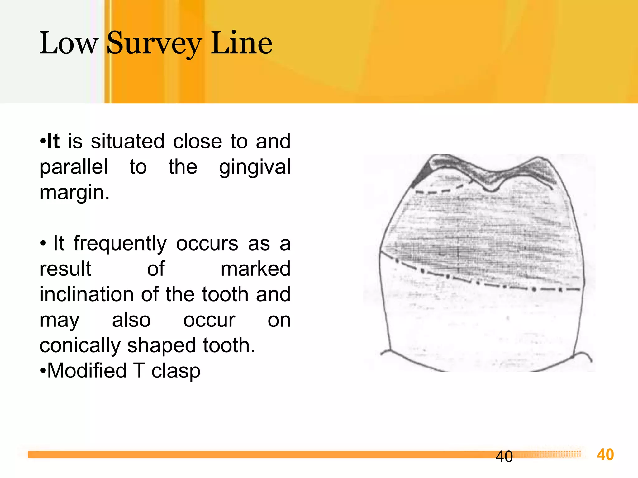 Surveyor and technique of Surveying in Removable partial denture | PPTX