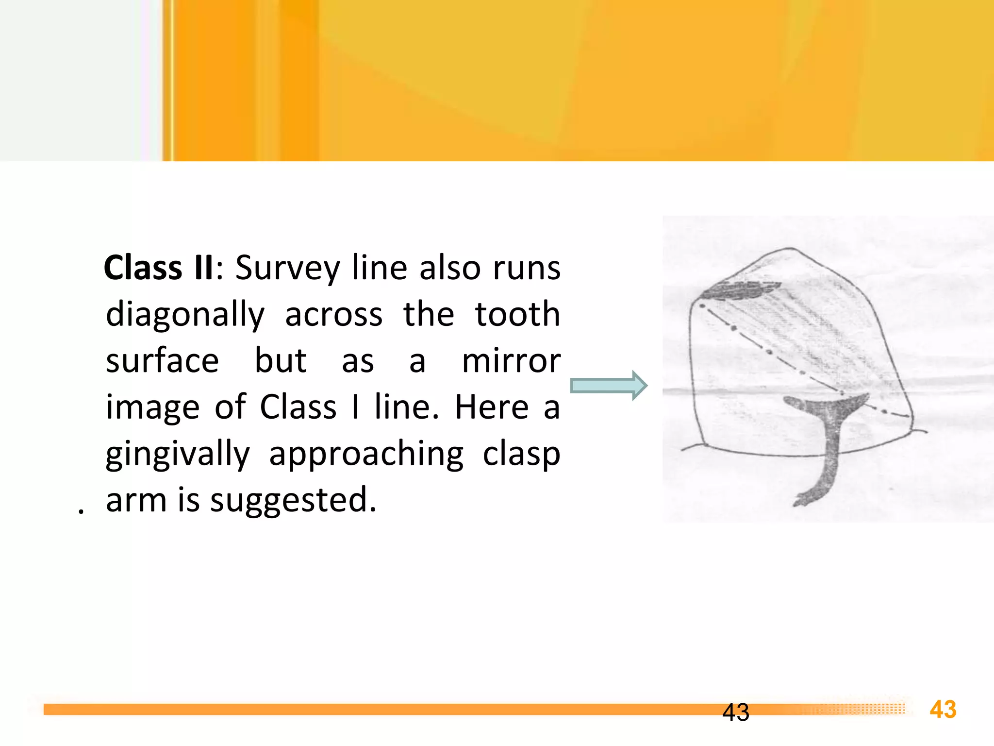 Surveyor and technique of Surveying in Removable partial denture | PPTX