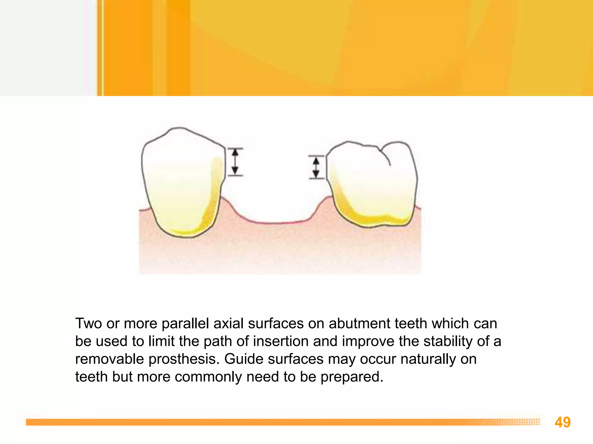 Surveyor and technique of Surveying in Removable partial denture | PPTX