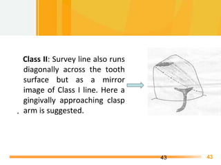 Surveyor and technique of Surveying in Removable partial denture | PPTX