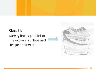 Surveyor and technique of Surveying in Removable partial denture | PPTX