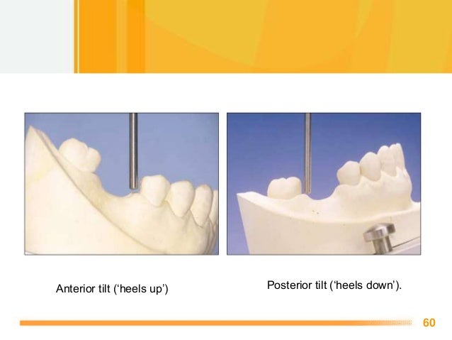 Surveyor and technique of Surveying in Removable partial denture