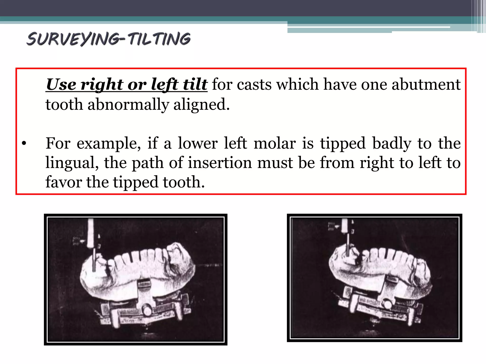 Dental Surveyor | PPTX