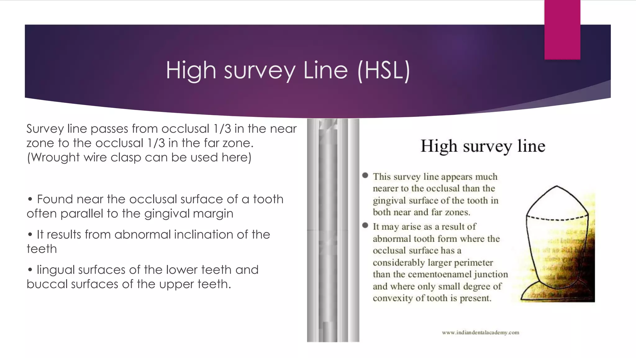 Dental Surveying | PDF