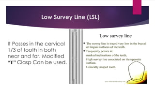 Dental Surveying | PDF | Dental Health | Diseases and Conditions