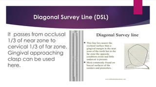 Dental Surveying | PDF | Dental Health | Diseases and Conditions