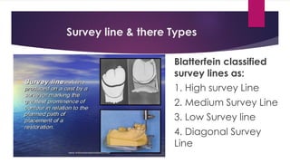 Dental Surveying | PDF | Dental Health | Diseases and Conditions