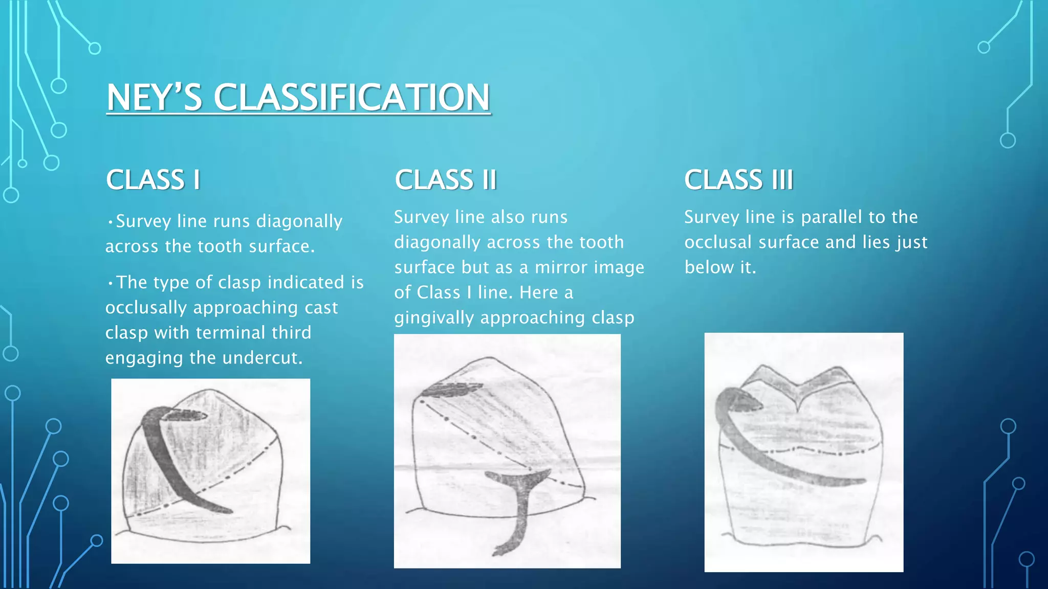 Surveying in Removable Prosthodontics | PPTX