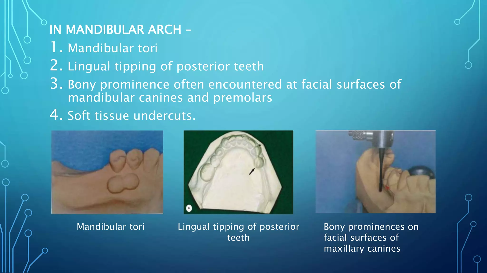 Surveying in Removable Prosthodontics | PPTX