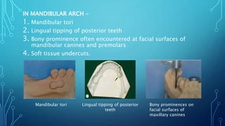 Surveying in Removable Prosthodontics | PPTX