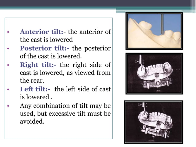 surveying-of diganostic cast and master cast.pptx | Oral care ...