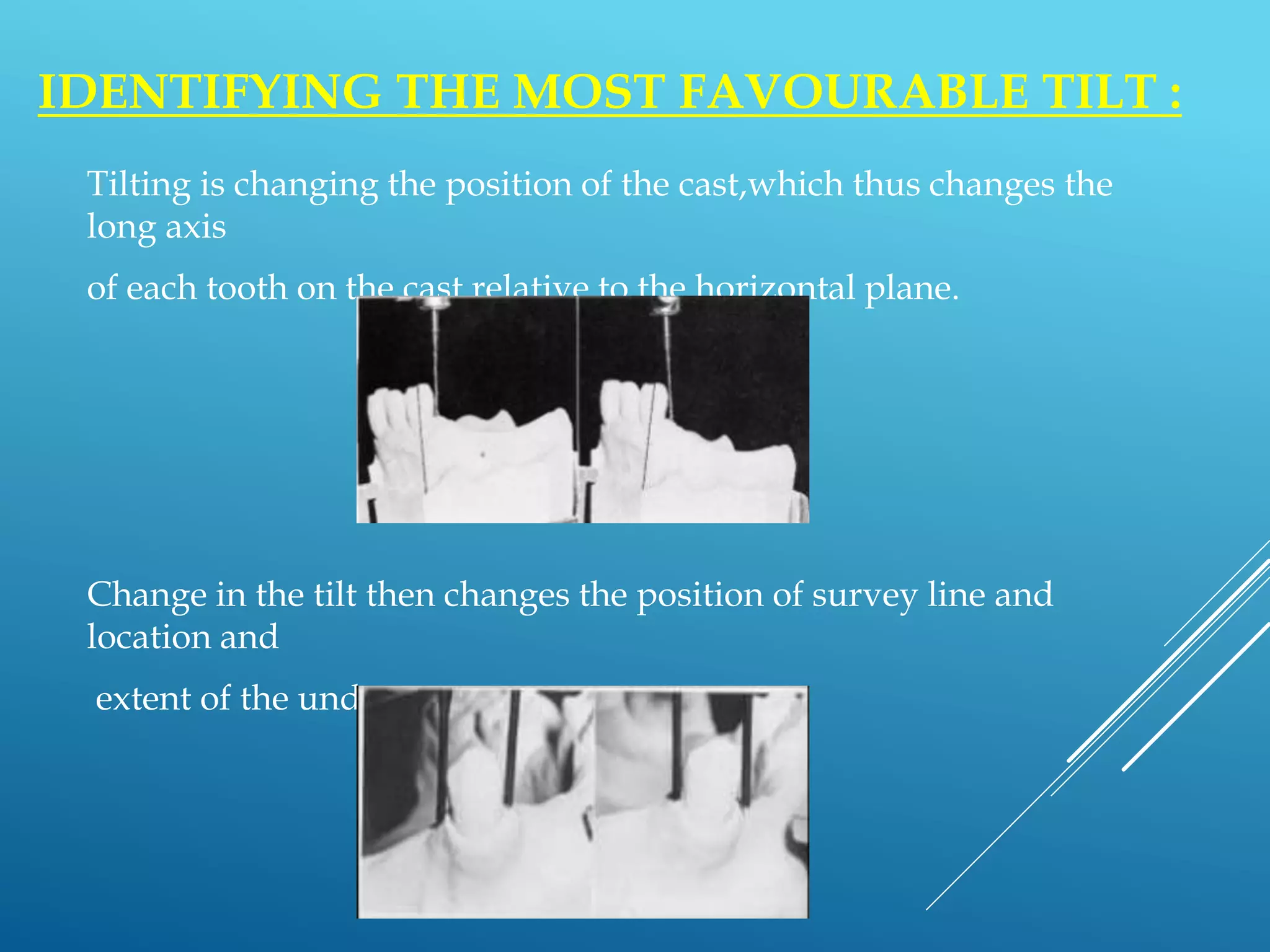 Surveyors and surveying in RPD | PPTX