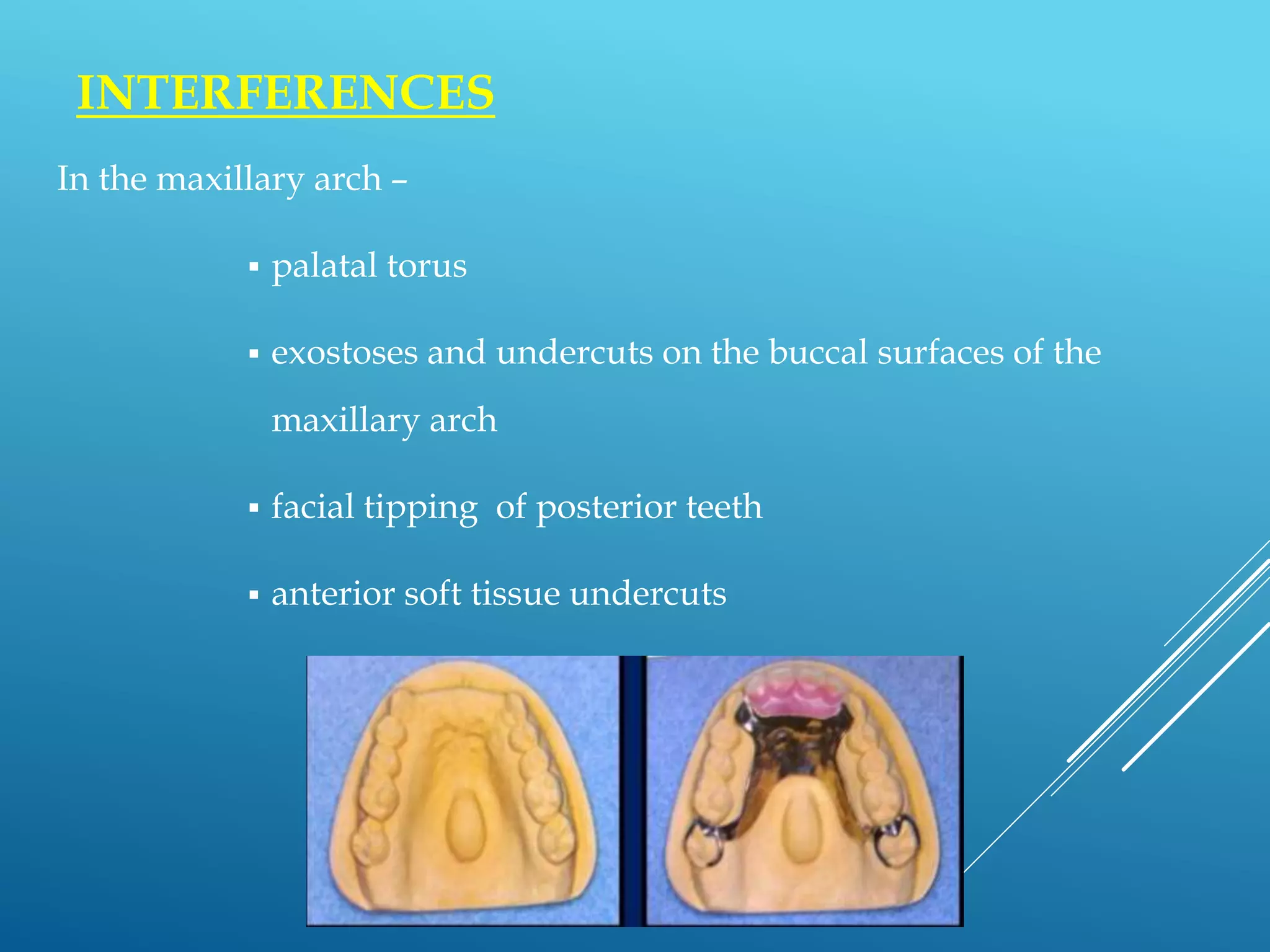 Surveyors and surveying in RPD | PPTX